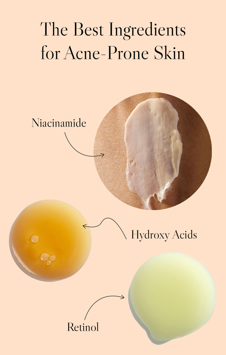 The Best Ingredients for Acne-Prone Skin